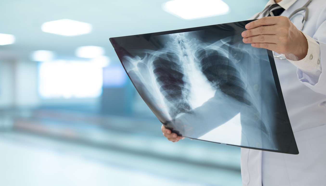 Estes são os sintomas de tuberculose para você ficar atento
