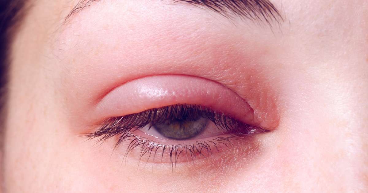 Blefarite: 8 sintomas que surgem no olho e merecem atenção